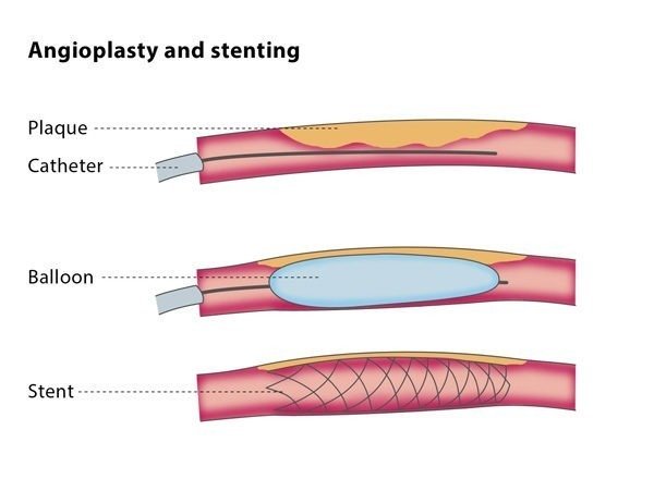 PEMBEDAHAN JANTUNG BYPASS ATAU STENTING? | Dr Zubaidi Hj Ahmad Menulis